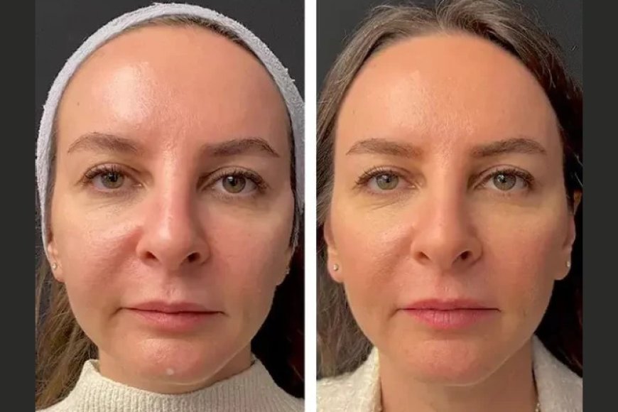 Mesotherapy for Double Chin: Treatments at the Best Aesthetic Clinic in ...